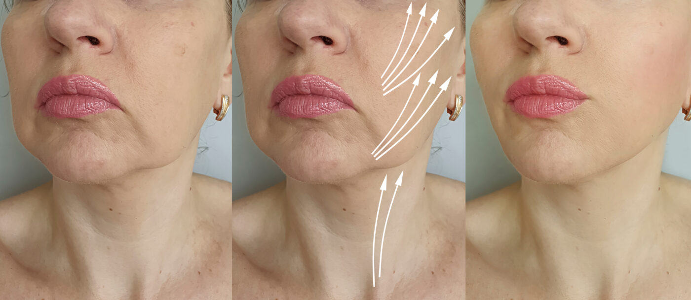 PROFHILO® Mallorca | Infos zu Behandlung und Kosten